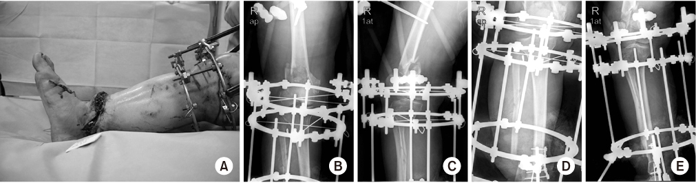 Major Limb Replantation of Lower Leg Amputation with Ipsilateral Distal ...